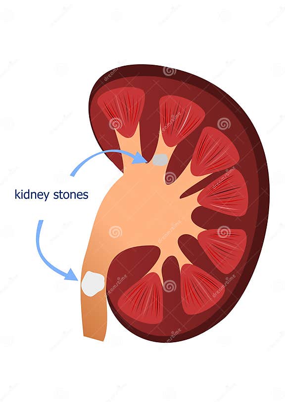 Kidney stones stock illustration. Illustration of science - 40575787