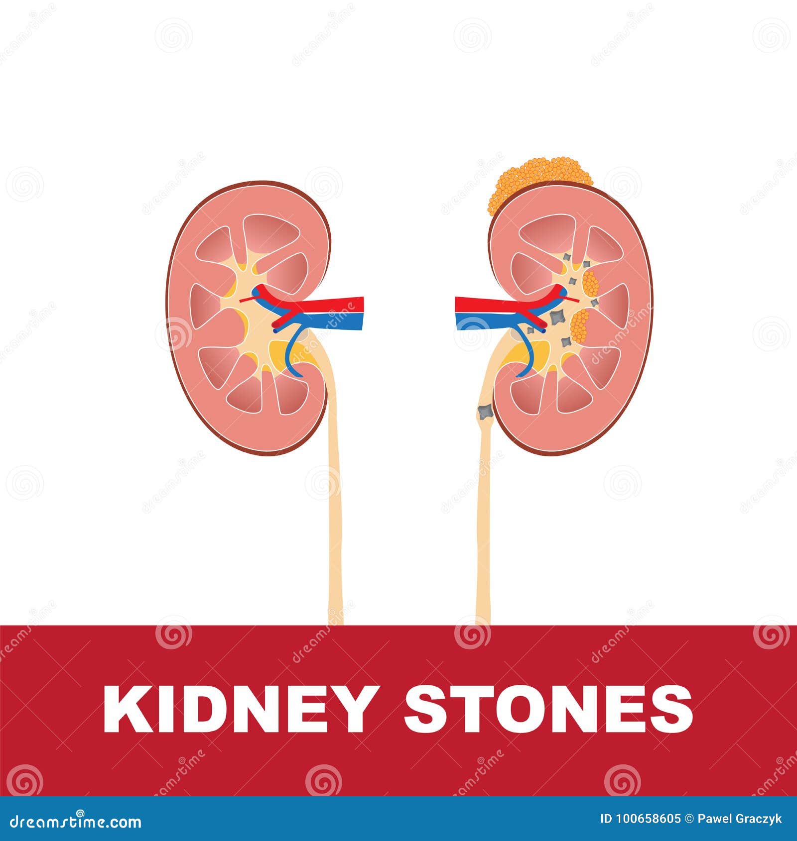 Kidney Stones Vector Illustration Stock Vector - Illustration of cross ...