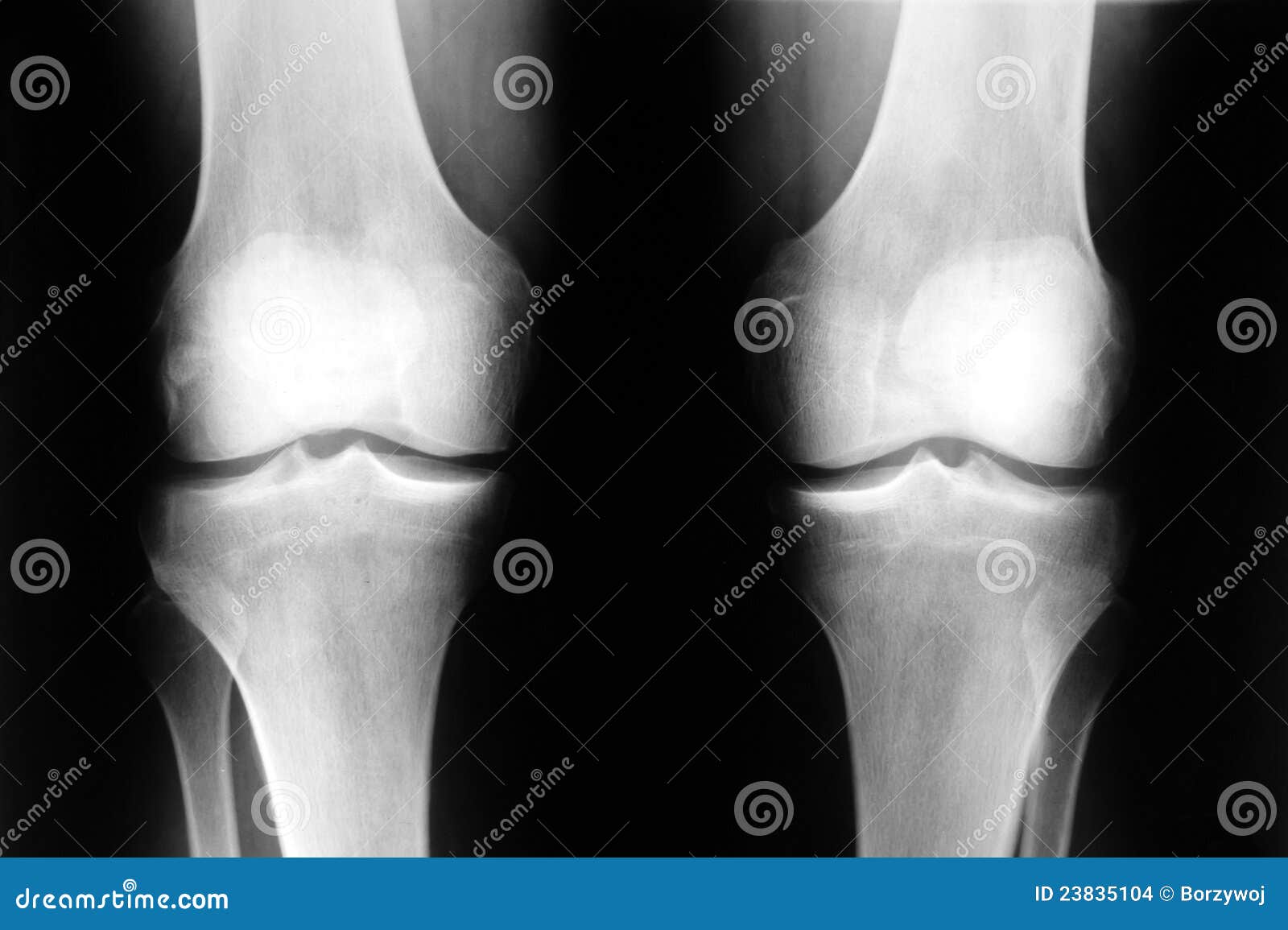 Knee Xray Of A Patient Showing A Lucent Line At Lower Part Of Patella ...
