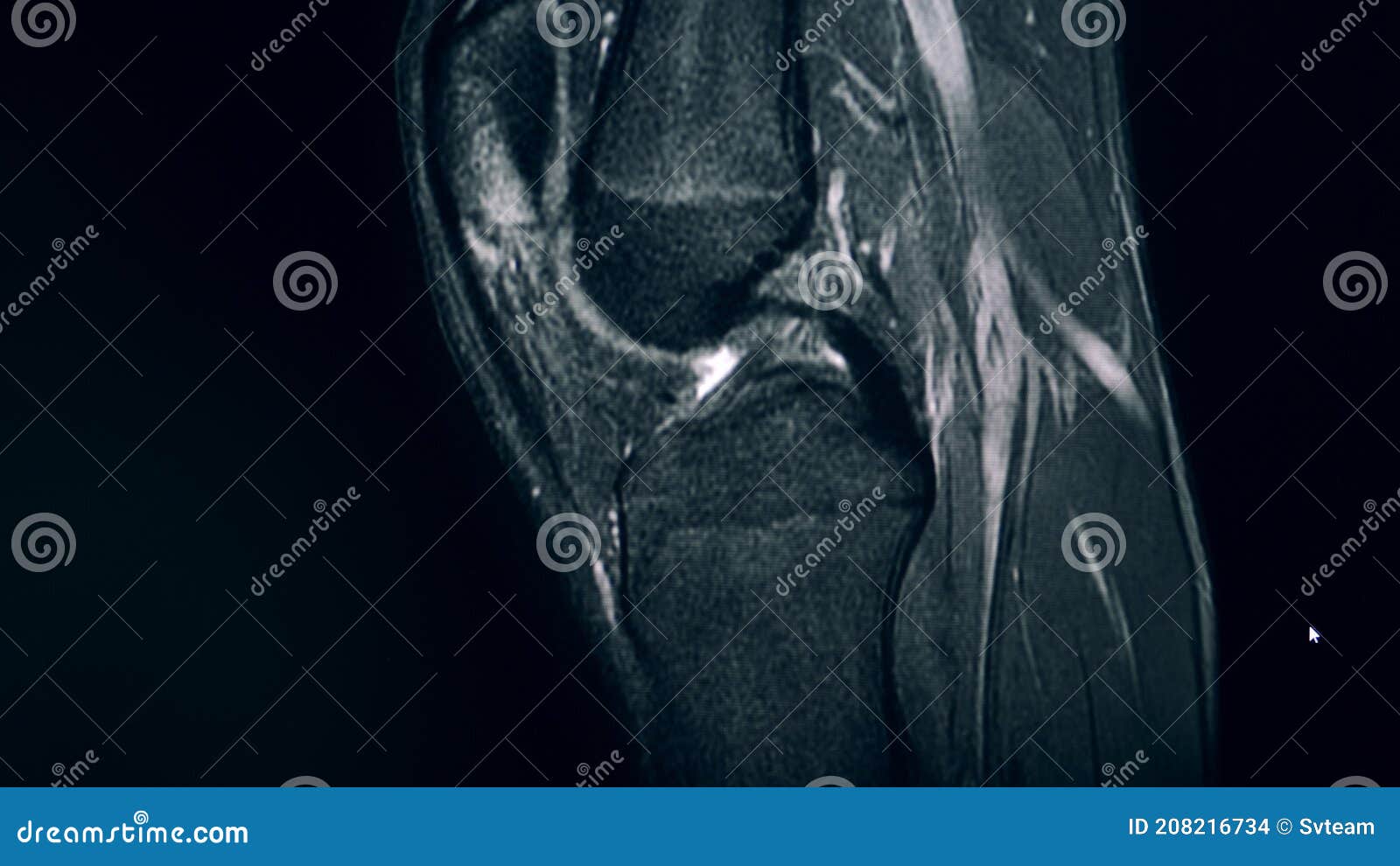 Knee Bones are Being Shown on MRI Scan Stock Footage - Video of ...