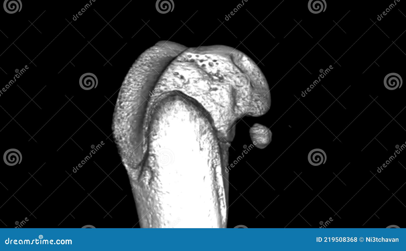 Knee 3d Rendering Image Rotating on the Screen and 2D Sagittal View ...