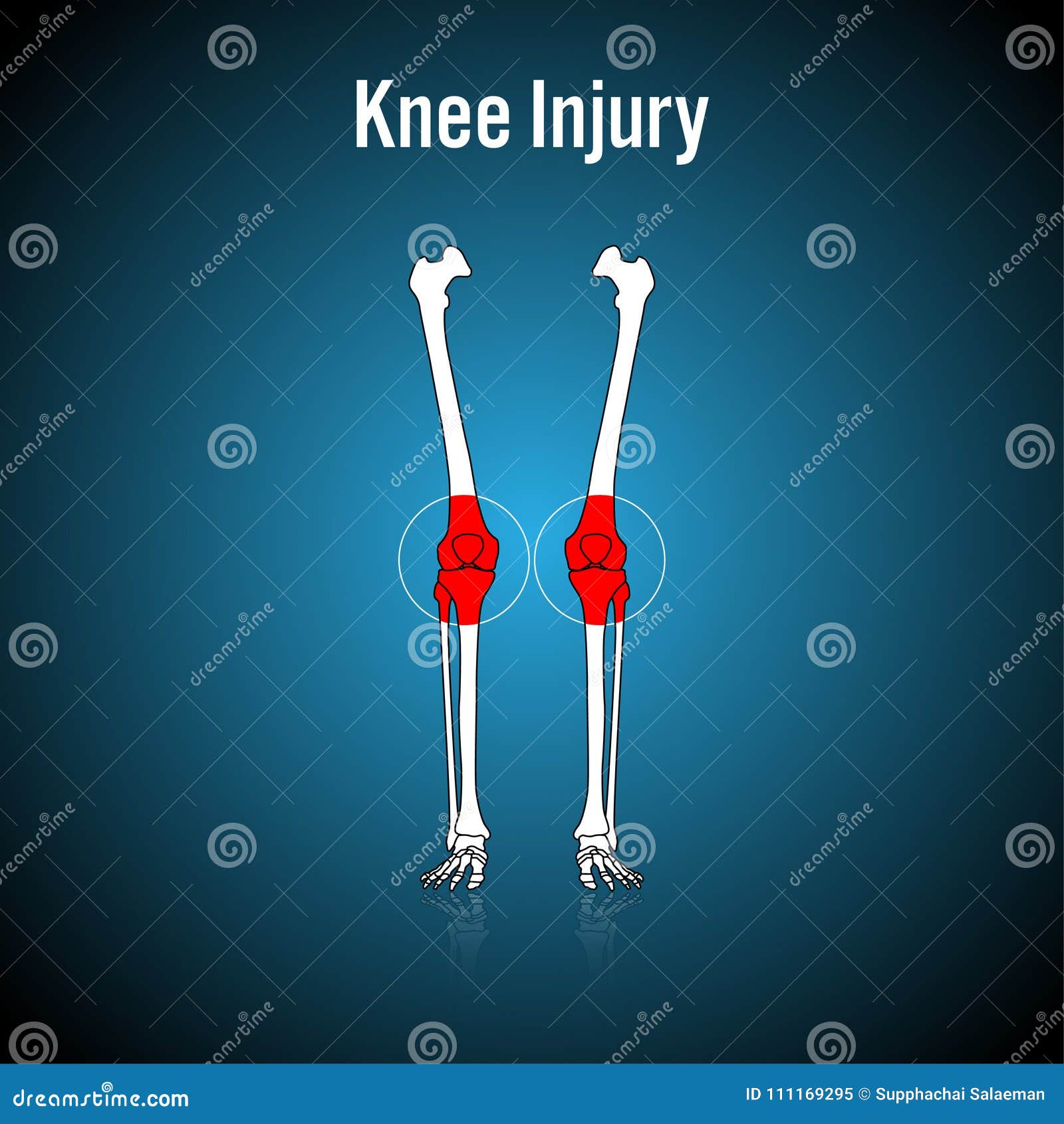 Knee injury stock vector. Illustration of hospital, mark - 111169295