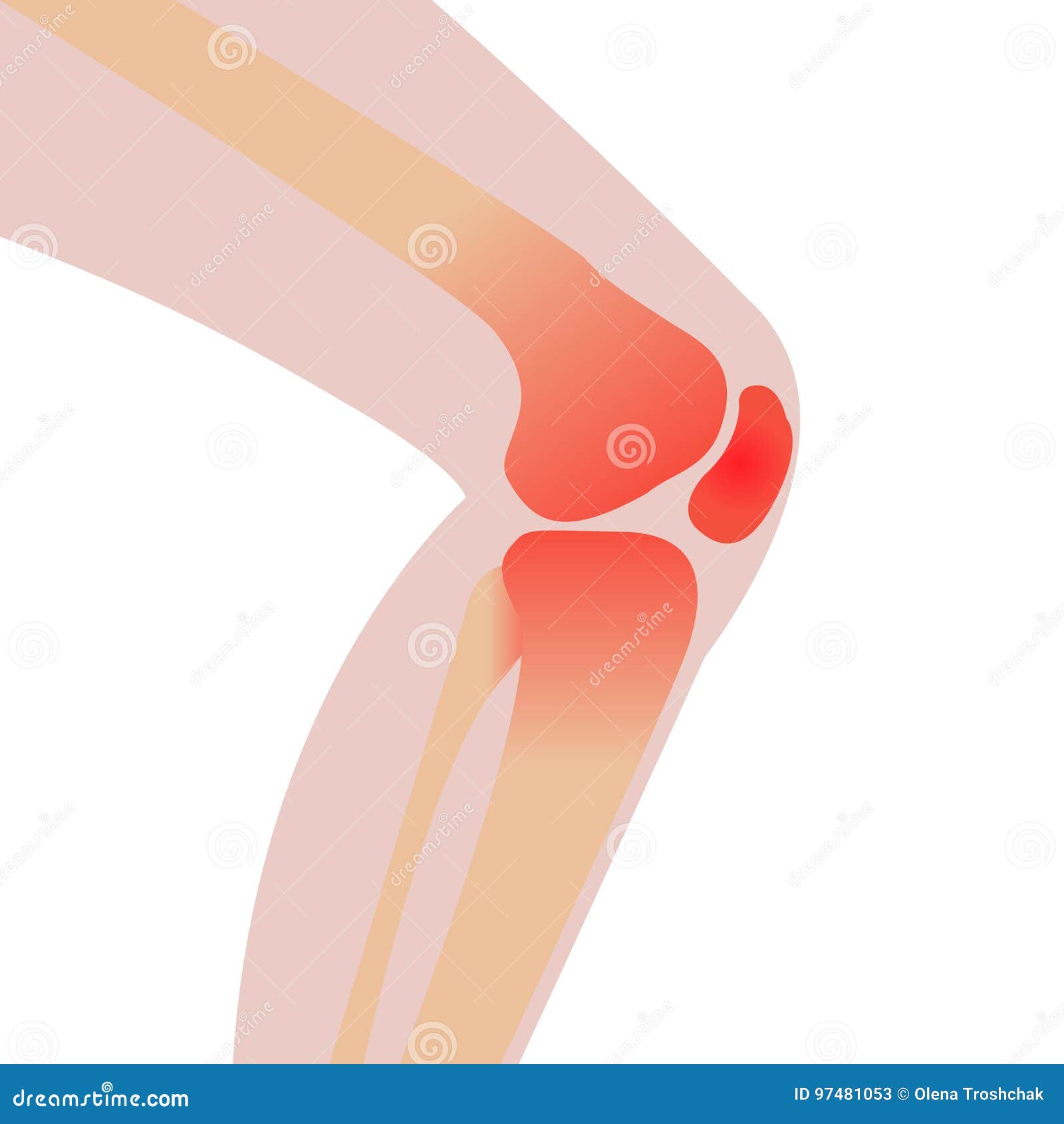 Knee injury stock vector. Illustration of healthcare - 97481053