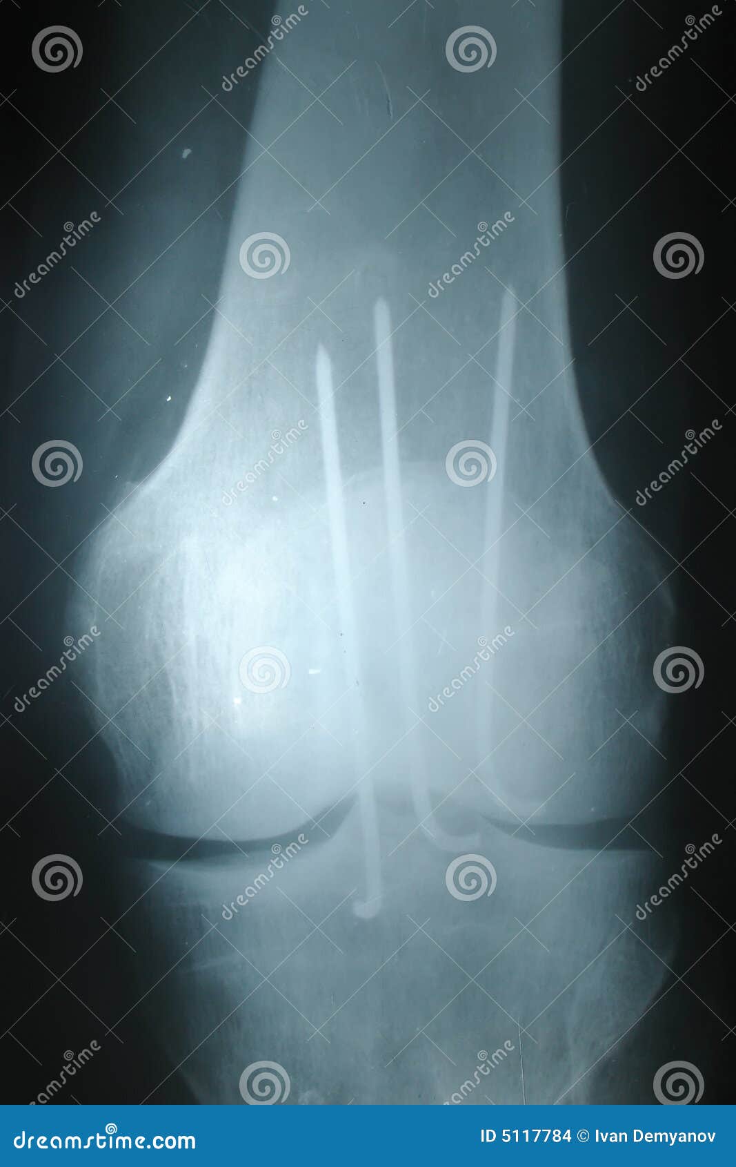 Knee joint stock photo. Image of arthritis, accident, biology - 5117784