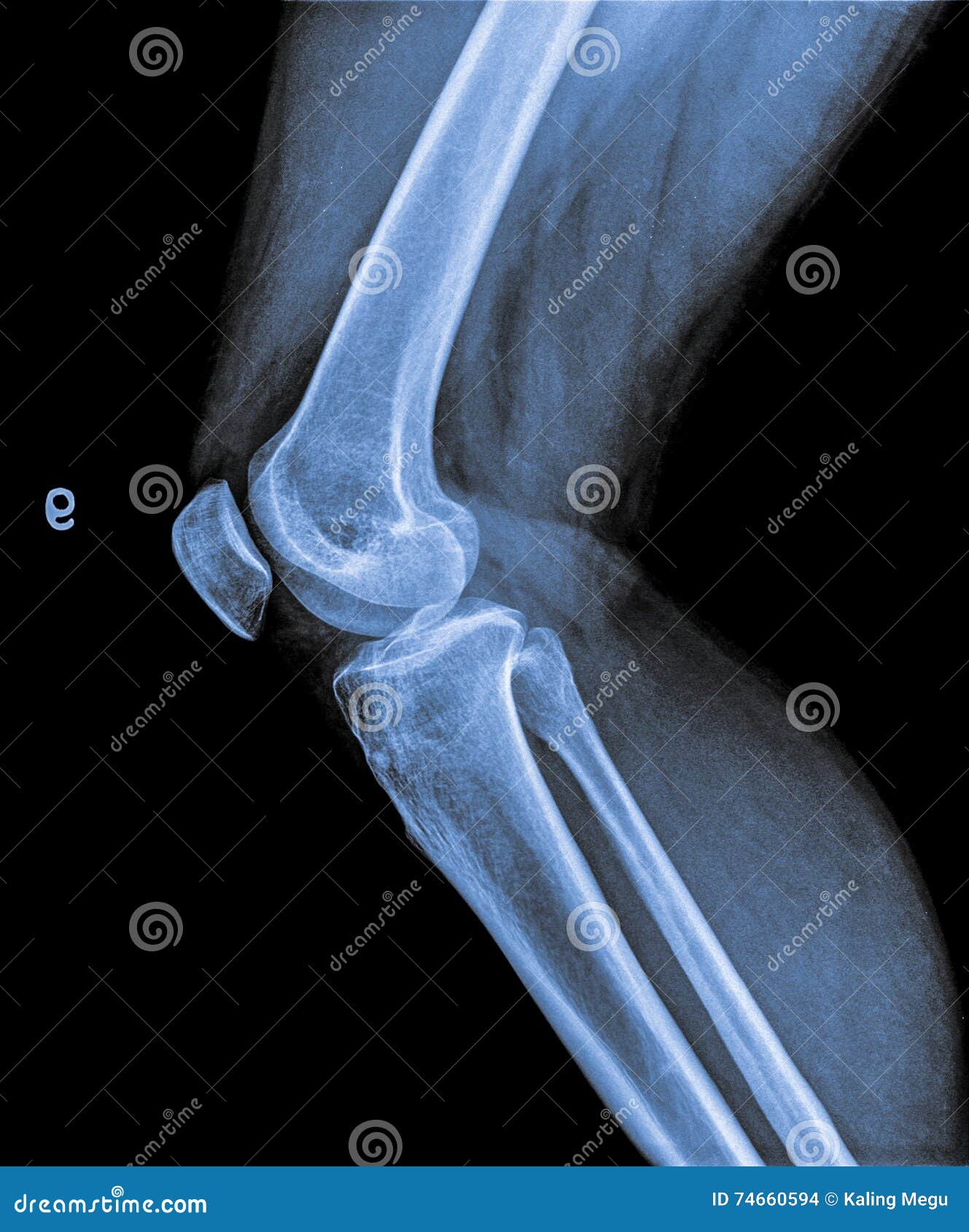 Knee Joint with Femur and Tibia Stock Photo - Image of femur, tibia ...