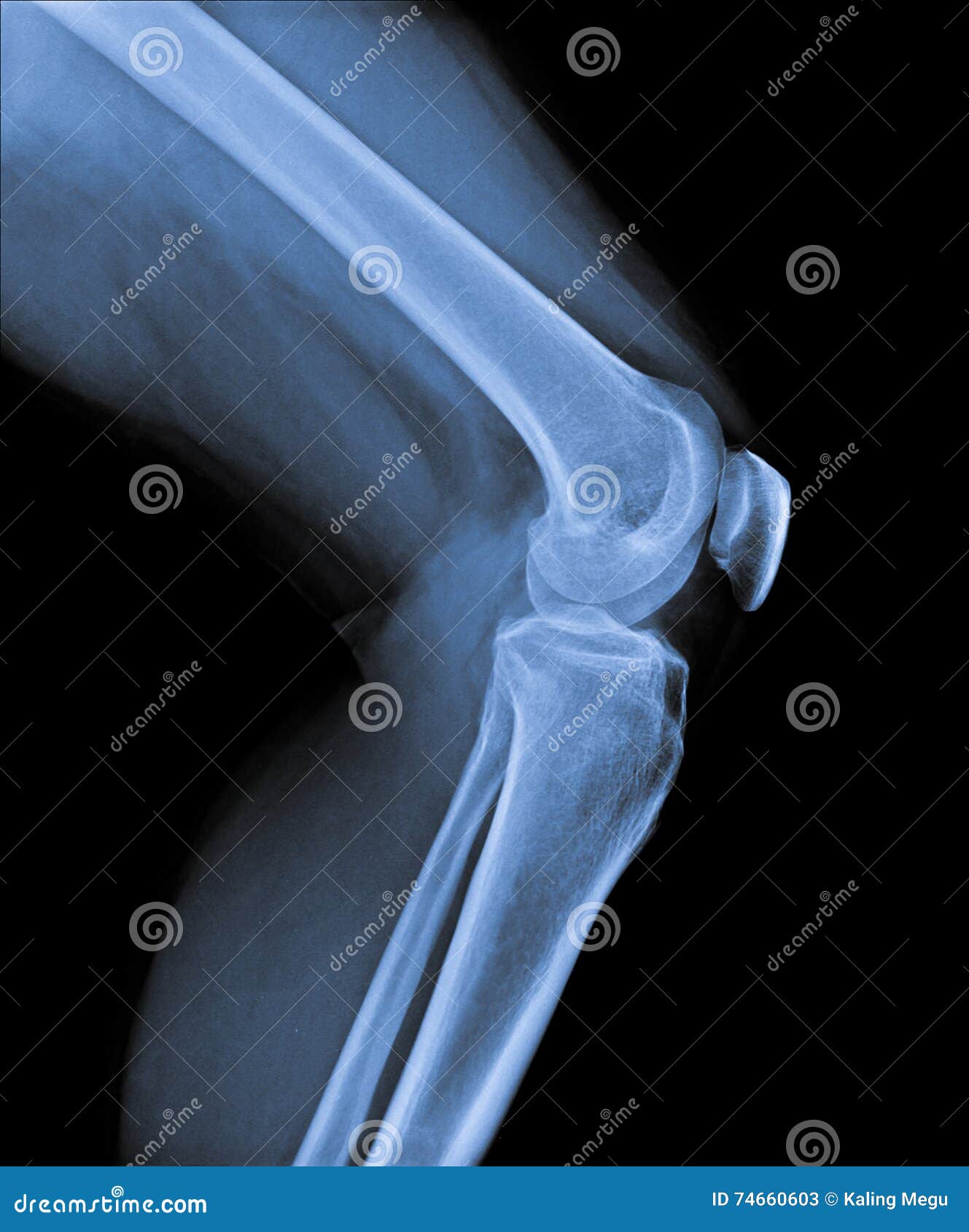 Knee Joint with Femur and Tibia Stock Image - Image of health, knee ...