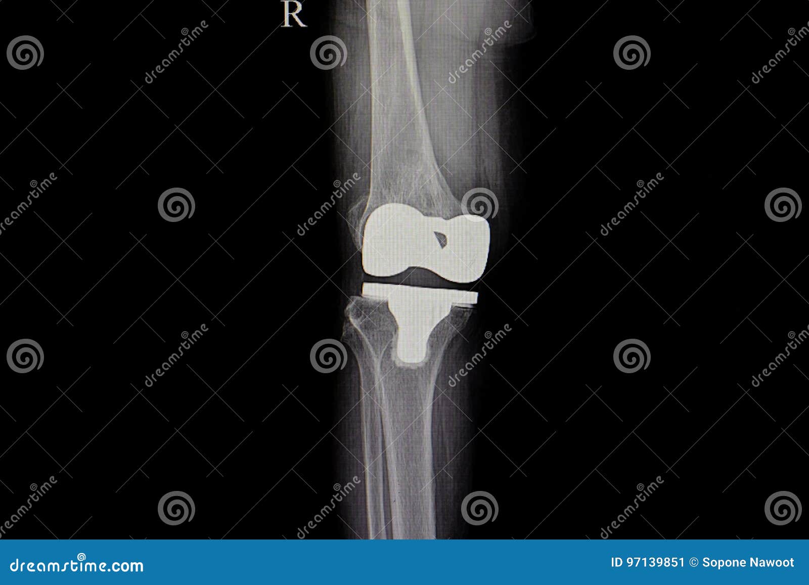 Knee joint film stock image. Image of medicine, human - 97139851