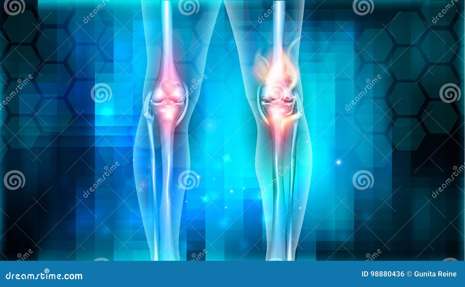 Knee joint problems stock vector. Illustration of joint - 98880436