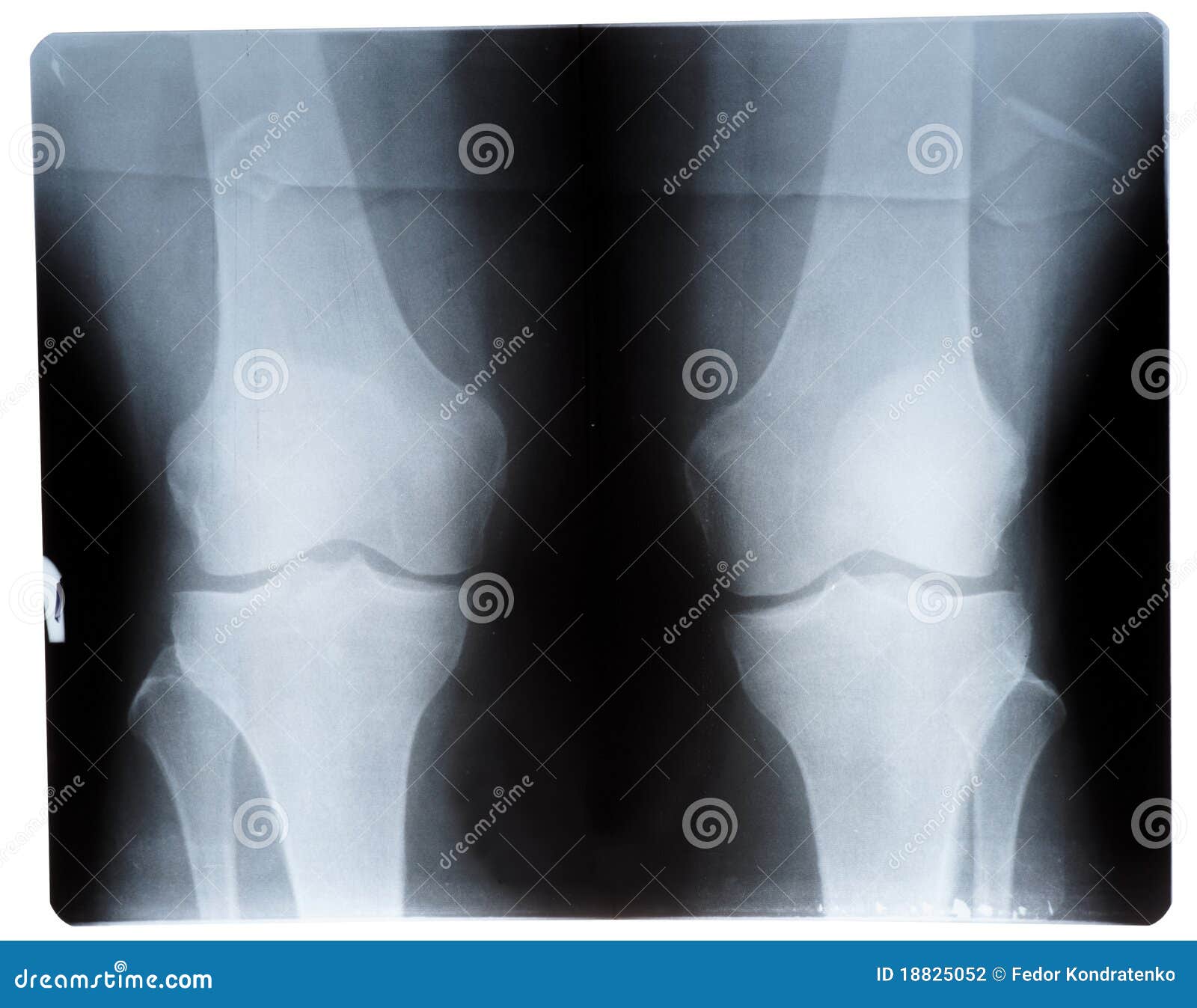 Knee Joint X-ray, Front View Stock Photo - Image of healthcare, view ...