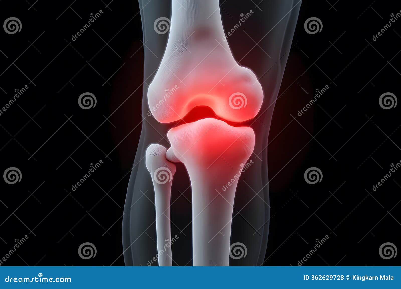 The Knee is the Joint between the Upper and Lower Legs. it is Joint ...
