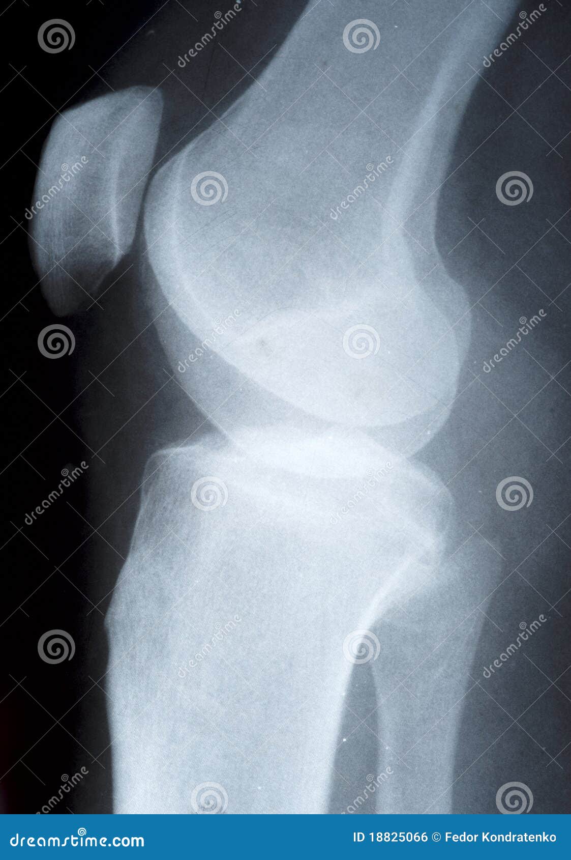 Knee Joint X-ray, Side View Royalty Free Stock Image - Image: 18825066