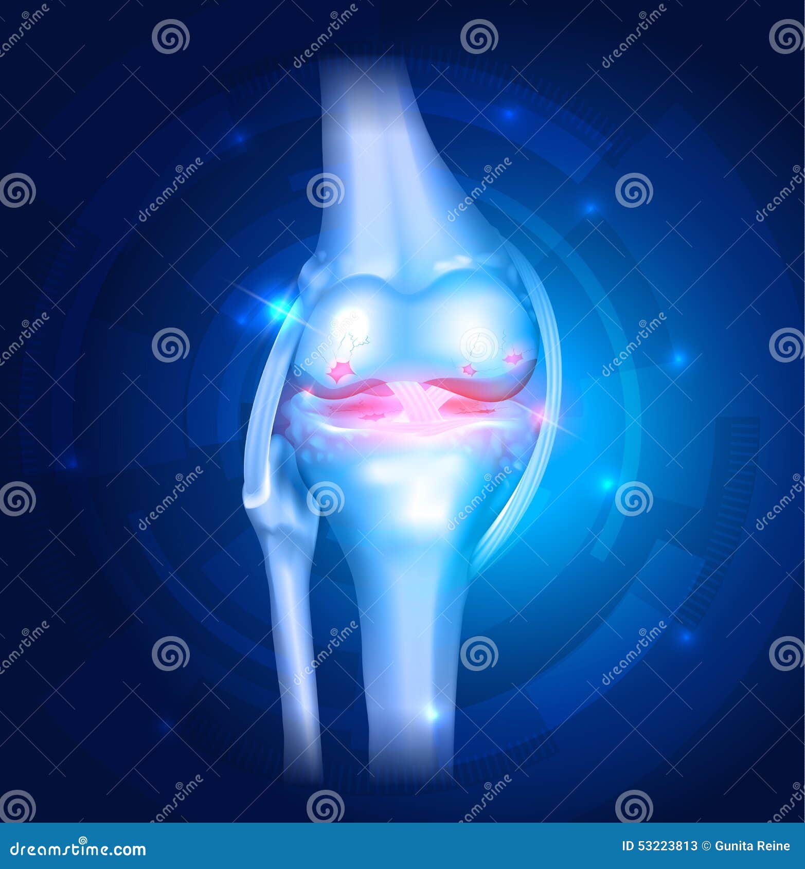 Knee Osteoarthritis Abstract Blue Background Stock Vector ...