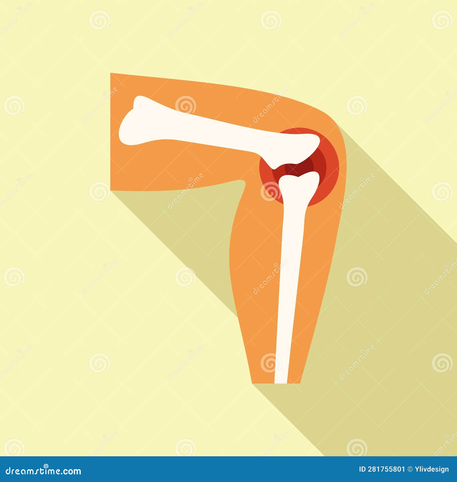 Knee Problem_Quadriceps Tendon Rupture Cartoon Vector | CartoonDealer ...