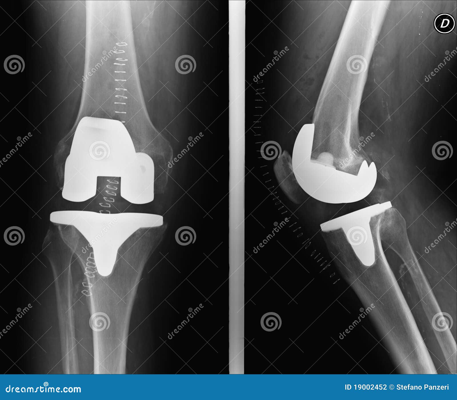 Knee with prosthesis stock photo. Image of female, recover - 19002452