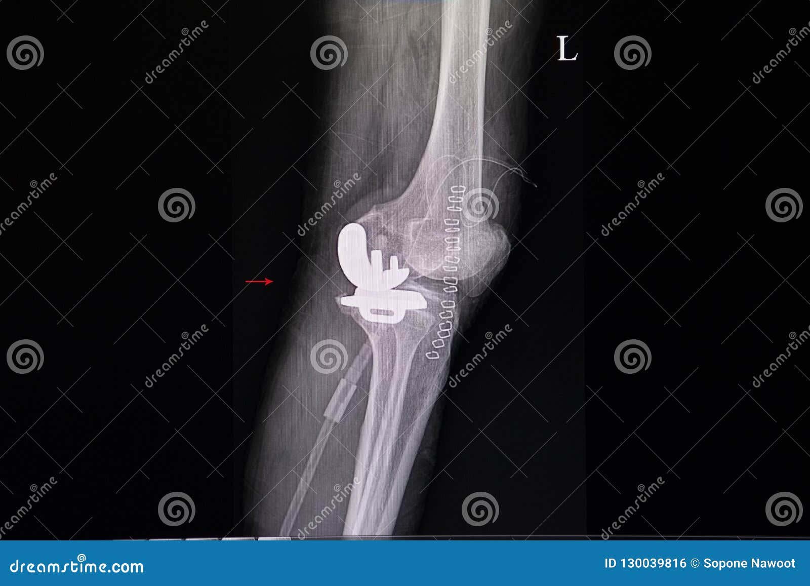 A knee prosthesis stock photo. Image of skeleton, patient - 130039816