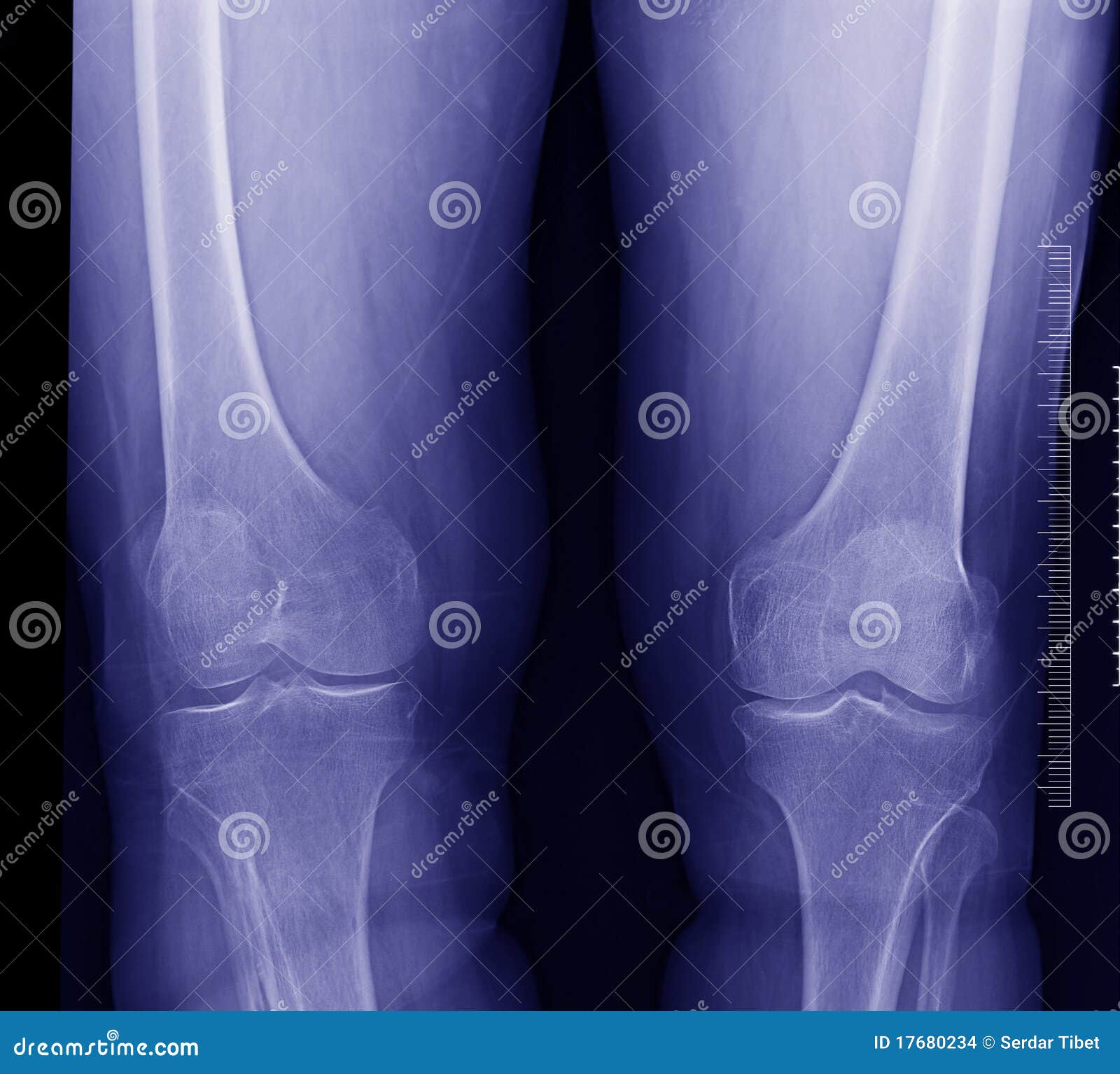 Knee x-ray stock photo. Image of anatomical, calf, hospital - 17680234