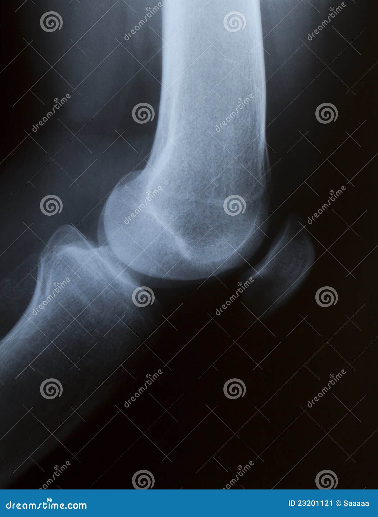 Knee X-ray stock image. Image of bone, roentgen, hospital - 23201121