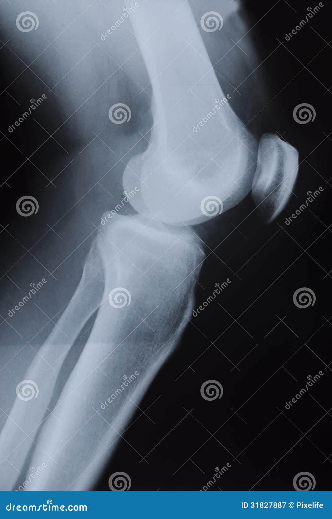 Knee x-ray stock image. Image of fracture, human, joint - 31827887