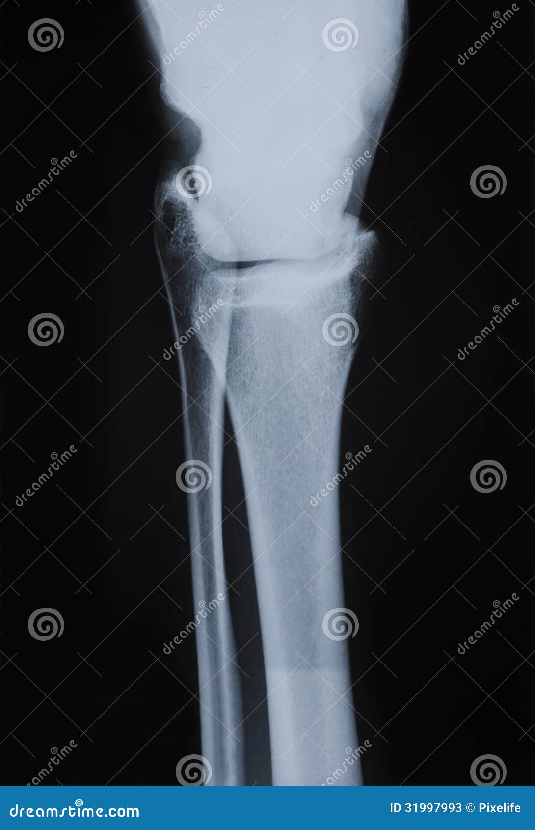 Knee x-ray stock image. Image of clinical, anatomy, kneecap - 31997993