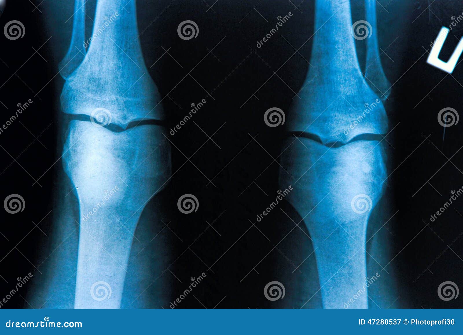 Knee x-ray stock image. Image of cruciate, anatomy, arthritis - 47280537