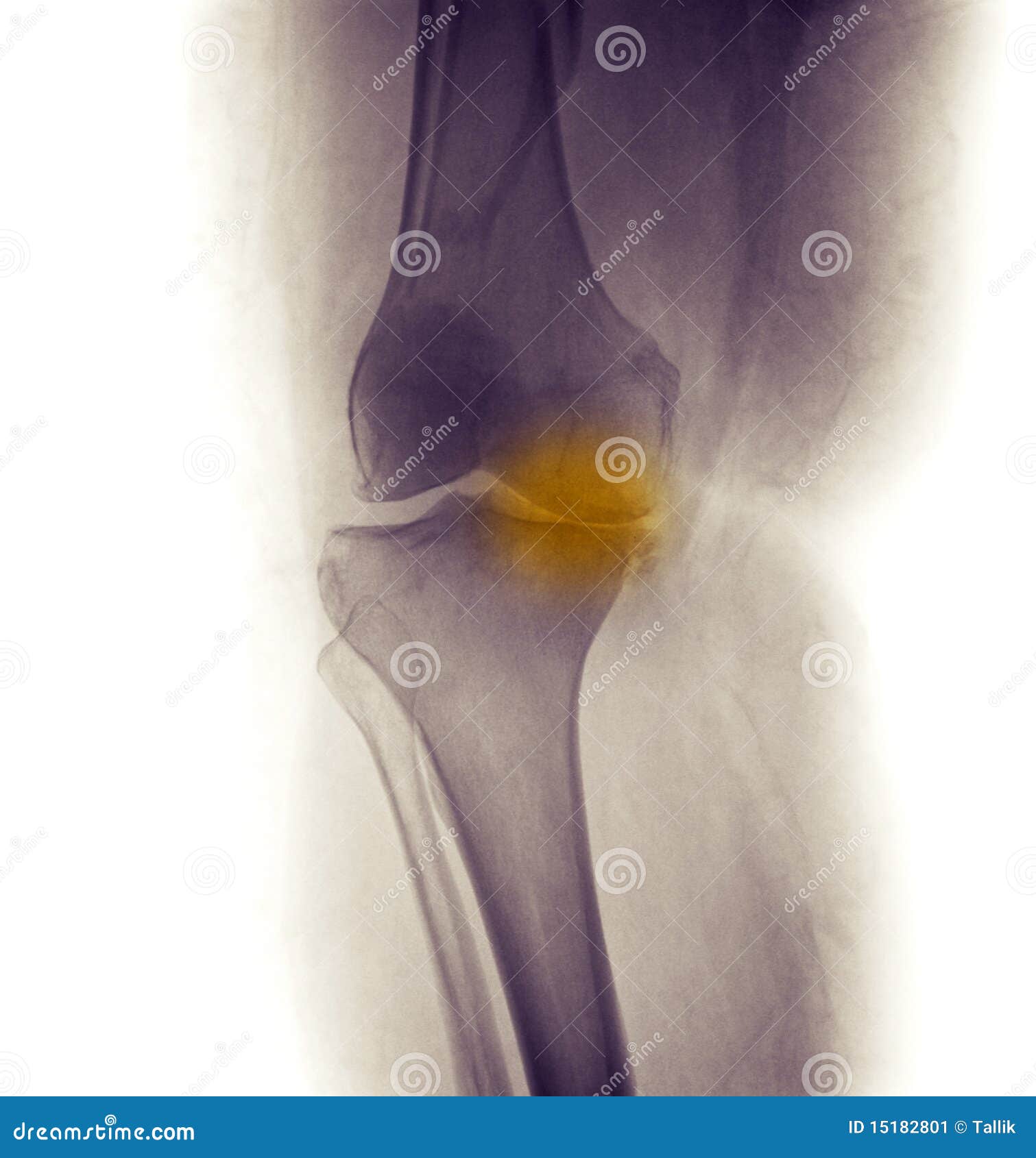 Knee X-ray, Severe Degenerative Osteoarthritis Stock Image - Image of ...