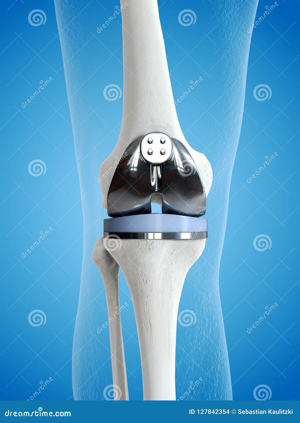 Knee Replacement. Joint Prosthetics. Knee Endoprosthesis. Vector ...