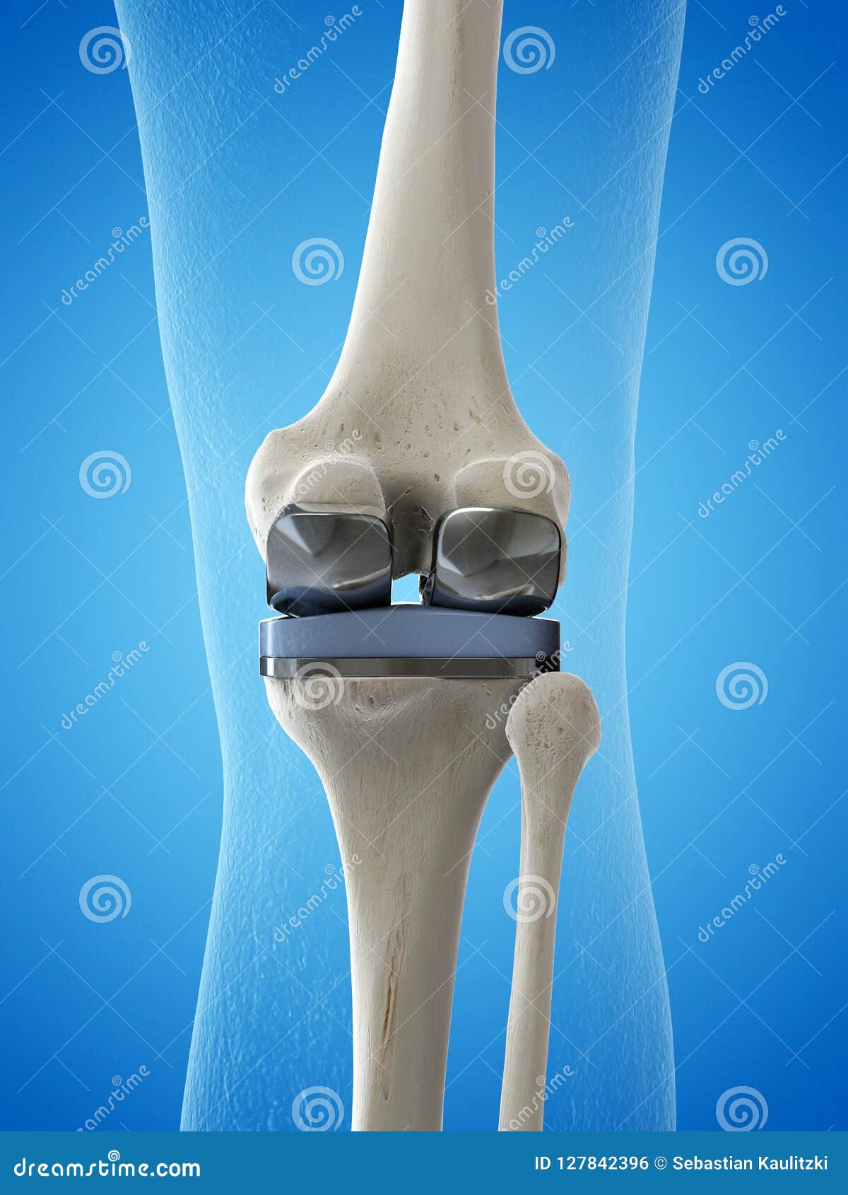 A knee replacement stock illustration. Illustration of knee - 127842396