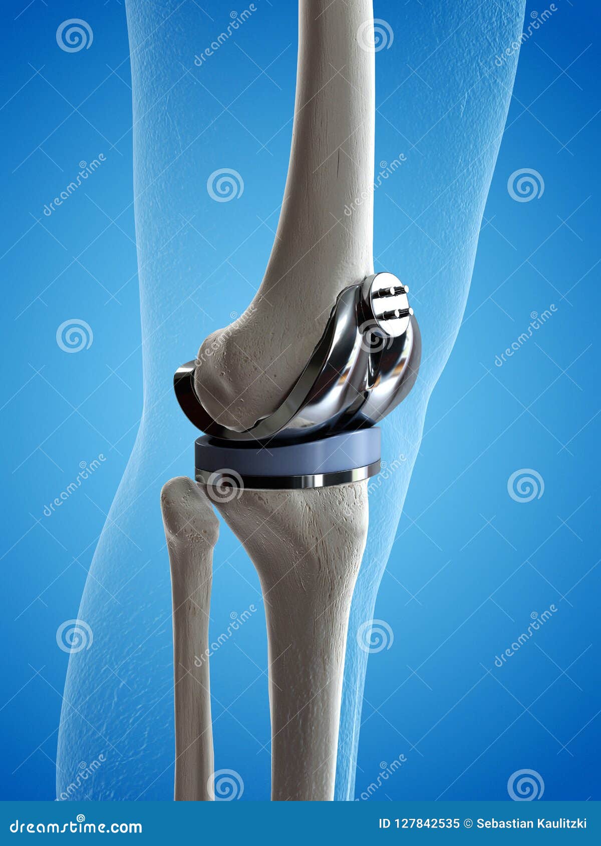 A knee replacement stock illustration. Illustration of rendering ...