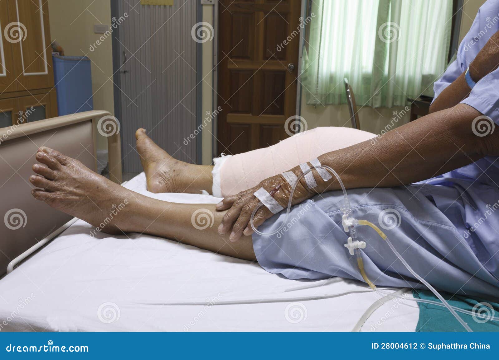 Knee replacement incision stock photo. Image of scar - 28004612