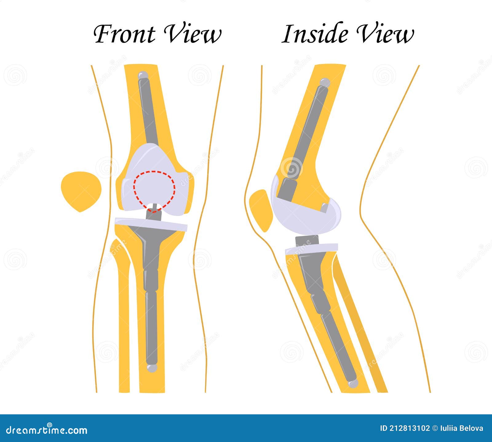 Knee Replacement. Joint Prosthetics. Knee Endoprosthesis. Vector ...