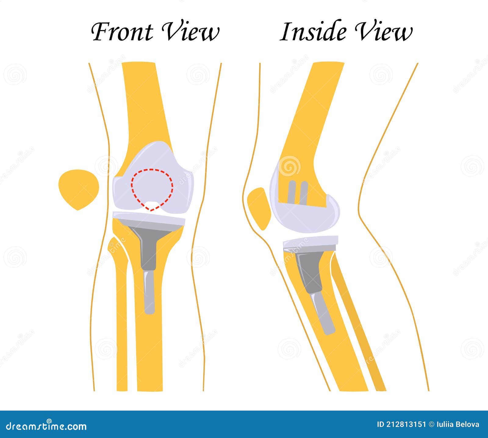 Knee Replacement. Joint Prosthetics. Knee Endoprosthesis. Vector ...