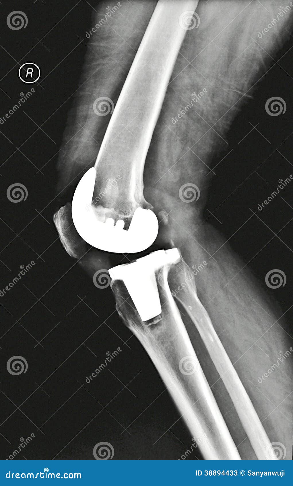 Knee Joint Ray Lateral Position Stock Photos - Free & Royalty-Free ...