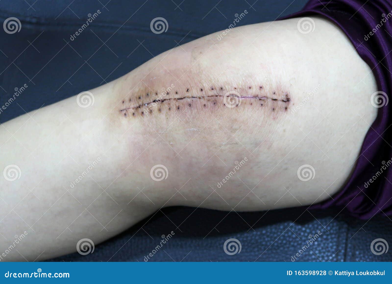 The Knee Replacement Surgery Lesions Stock Photo - Image of heal ...