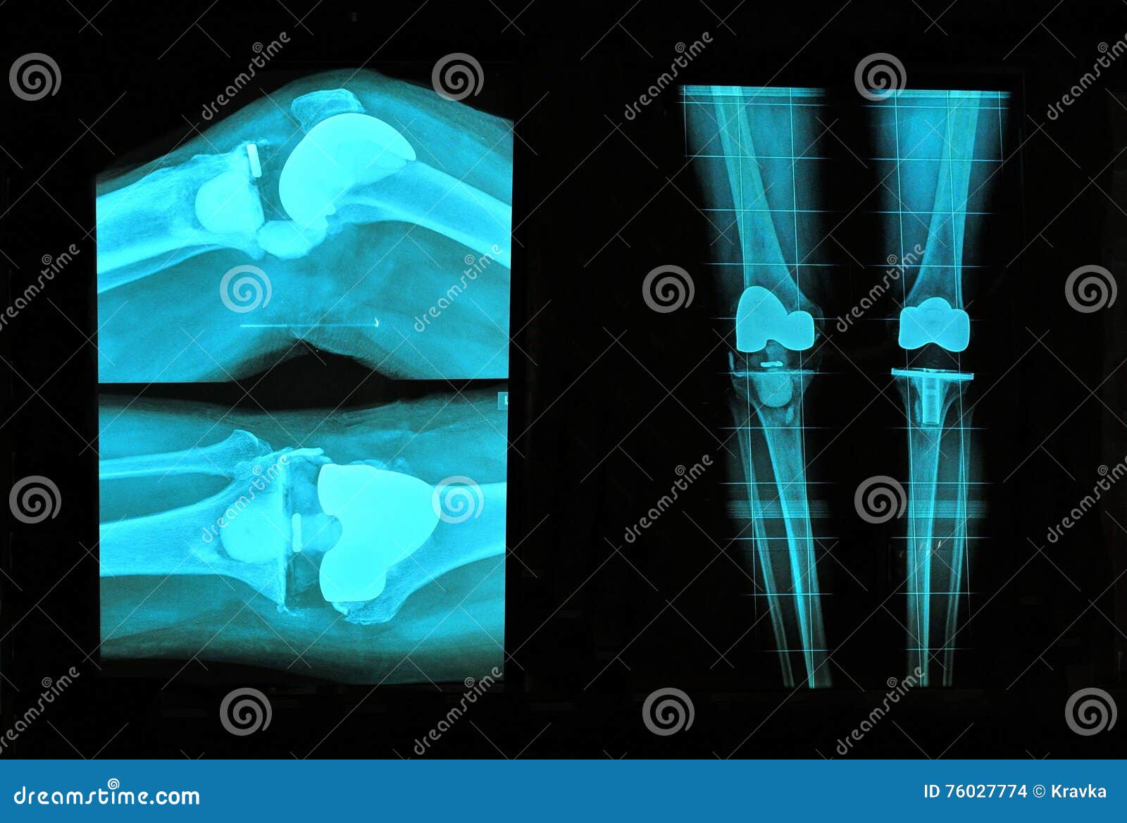 Knee replacement xray stock photo. Image of healthy, osteoarthritis ...