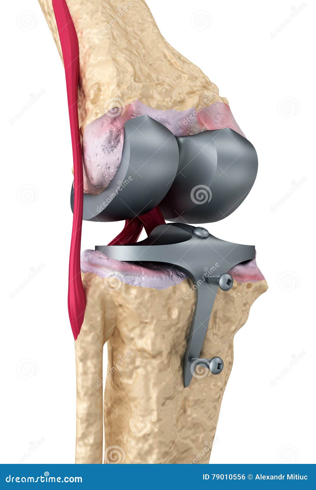 Knee And Titanium Hinge Joint Royalty-Free Stock Image | CartoonDealer ...