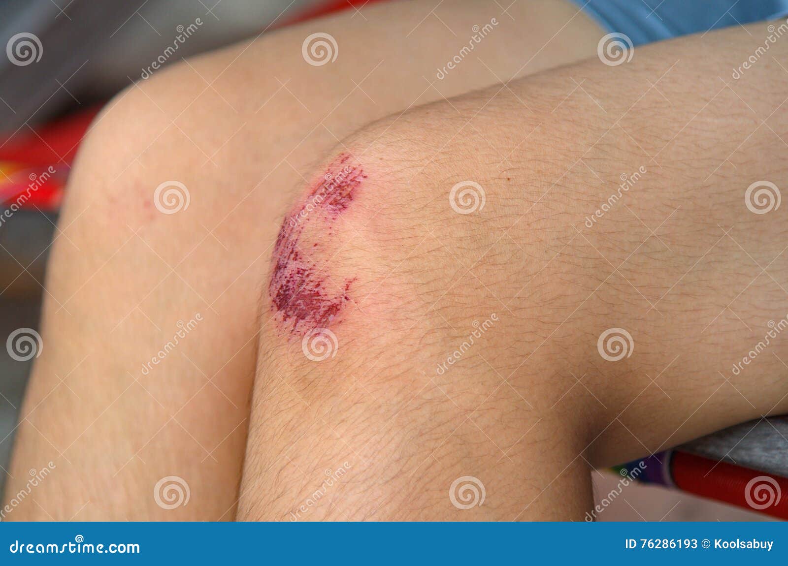 Knee wound accident. stock image. Image of background - 76286193