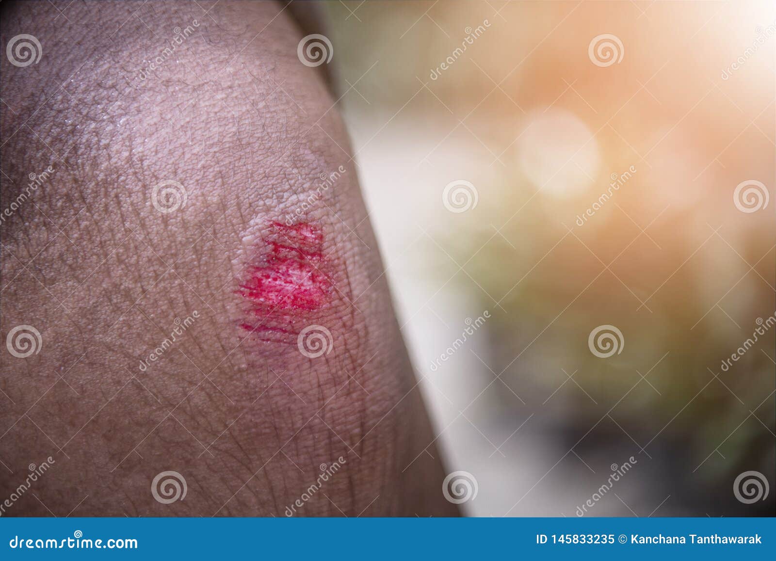 Knee Wound from Fall and Bleeding. Stock Image - Image of pain, person ...
