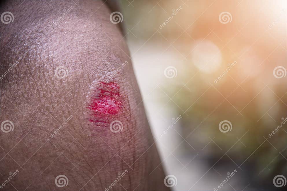 Knee Wound from Fall and Bleeding. Stock Image - Image of pain, person ...