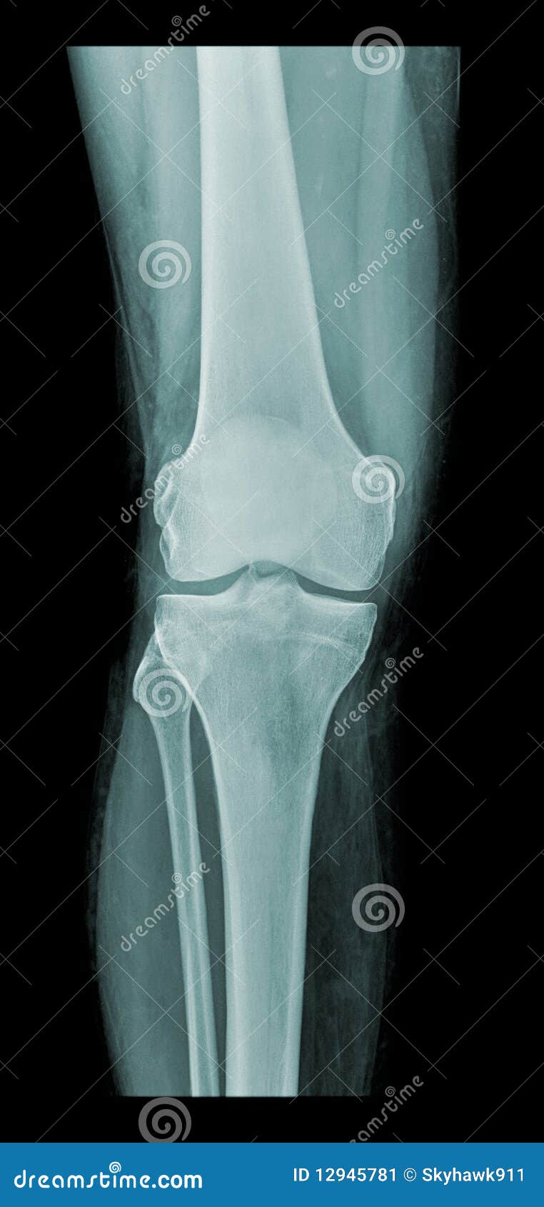 Knee X-ray Stock Image - Image: 12945781