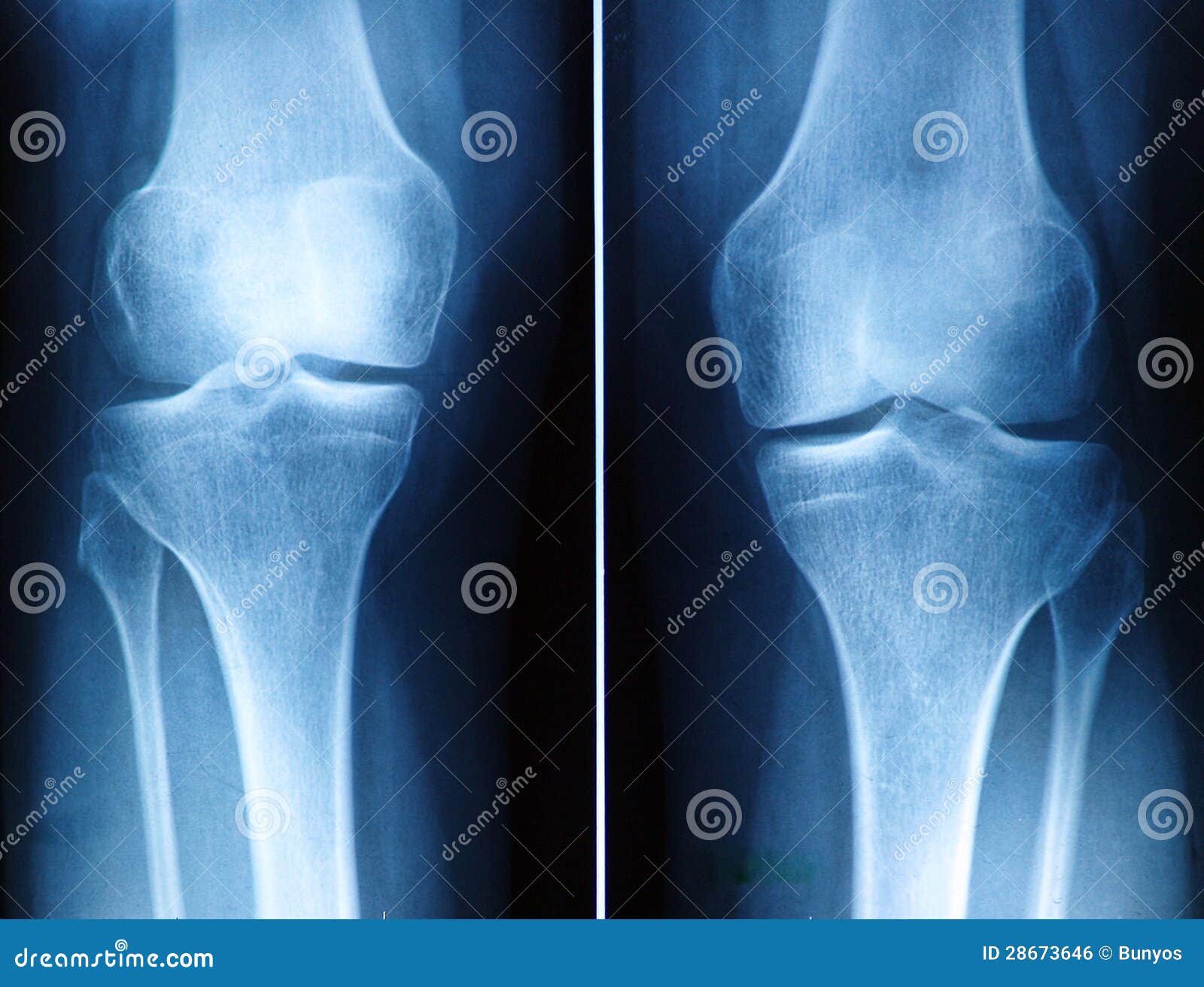 Knee X-ray Royalty Free Stock Image - Image: 28673646