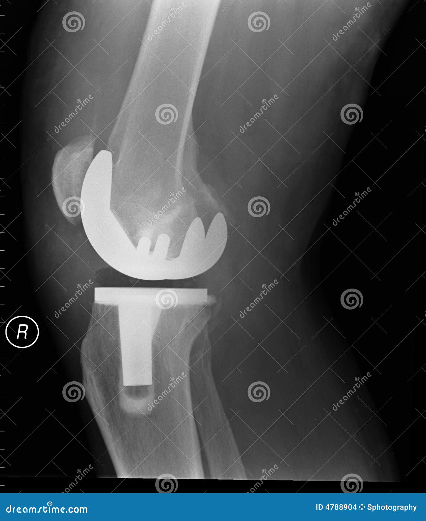 Radiography Of Titanium Plate To Support The Cervical Spine Stock ...