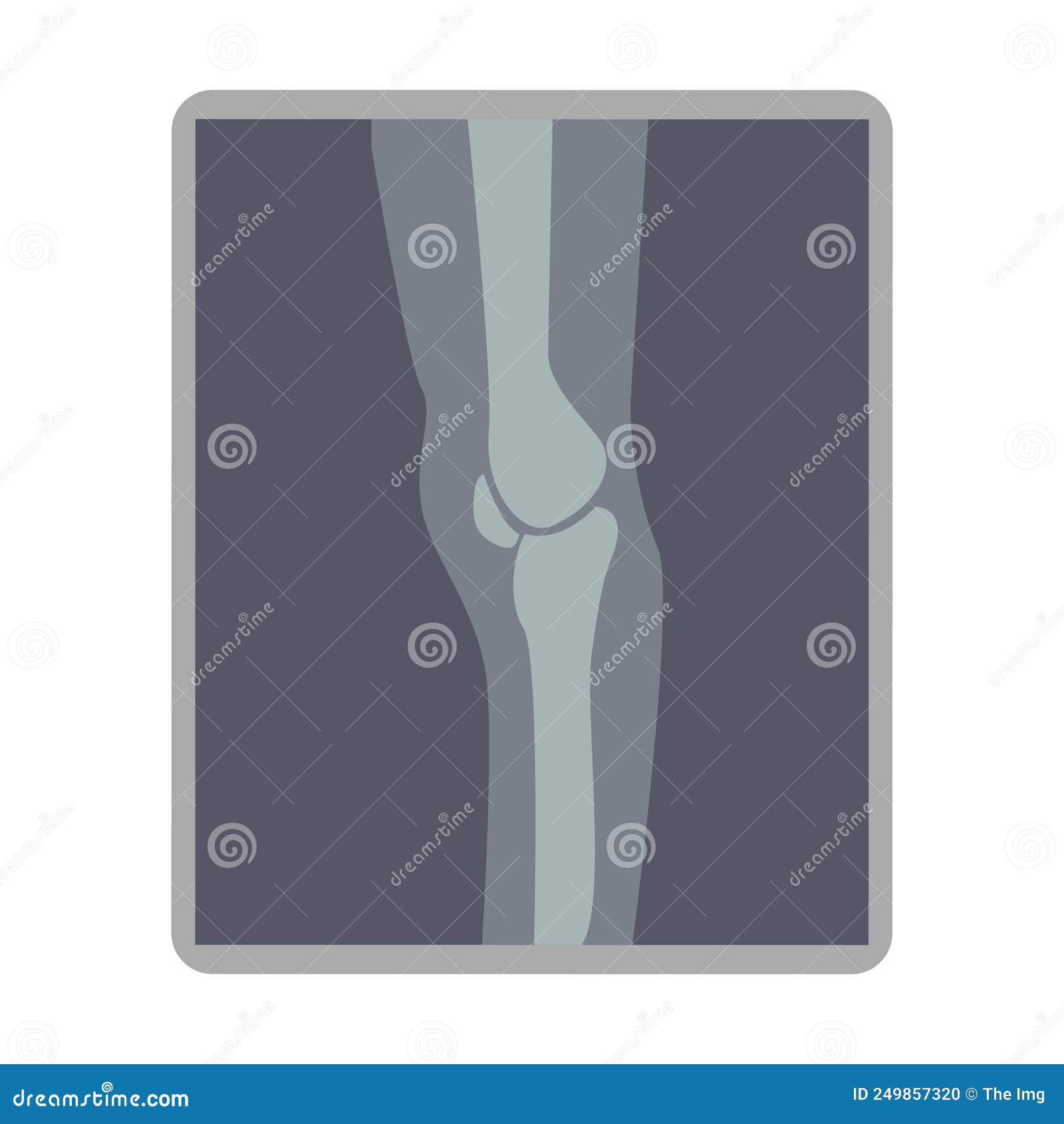 Avulsion Fracture Bone. Infographics. Vector Illustration On A Lined ...