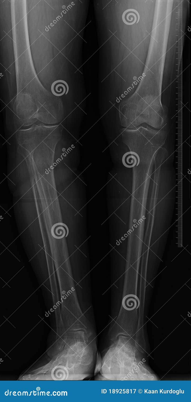 Knee Xray Of A Patient Showing A Lucent Line At Lower Part Of Patella ...