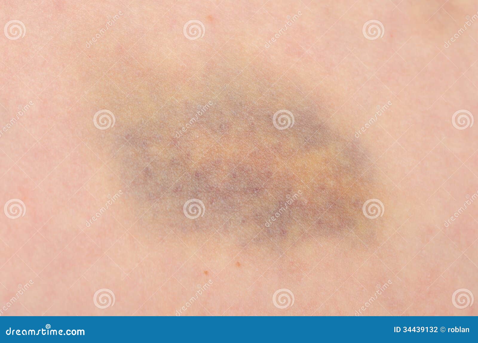 Kneuzing stock foto. Image of schuring, blauw, verwond - 34439132