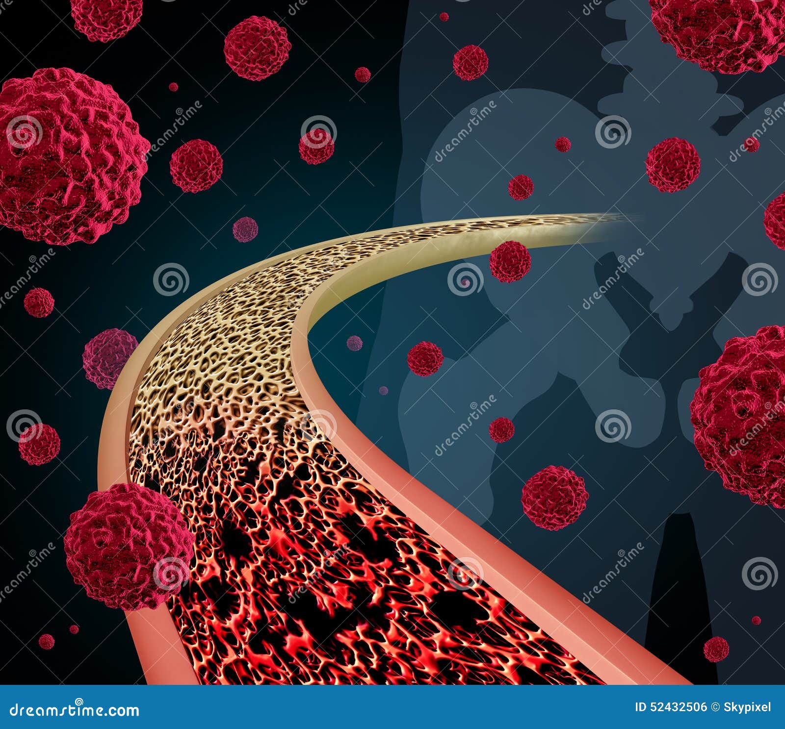 KNOCHEN-KREBS stock abbildung. Illustration von schwach - 52432506