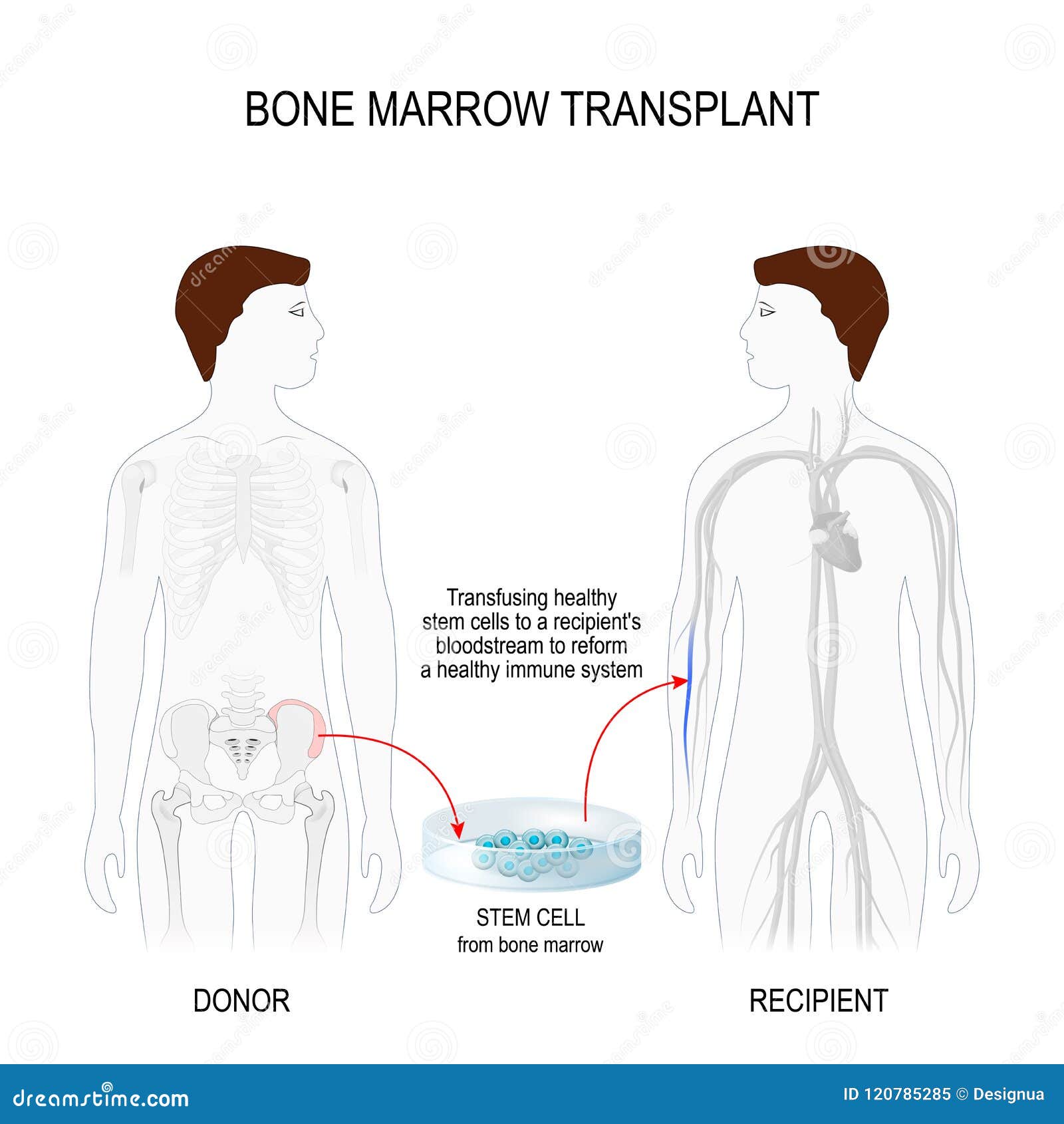 Knochenmarktransplantation vektor abbildung. Illustration von ...