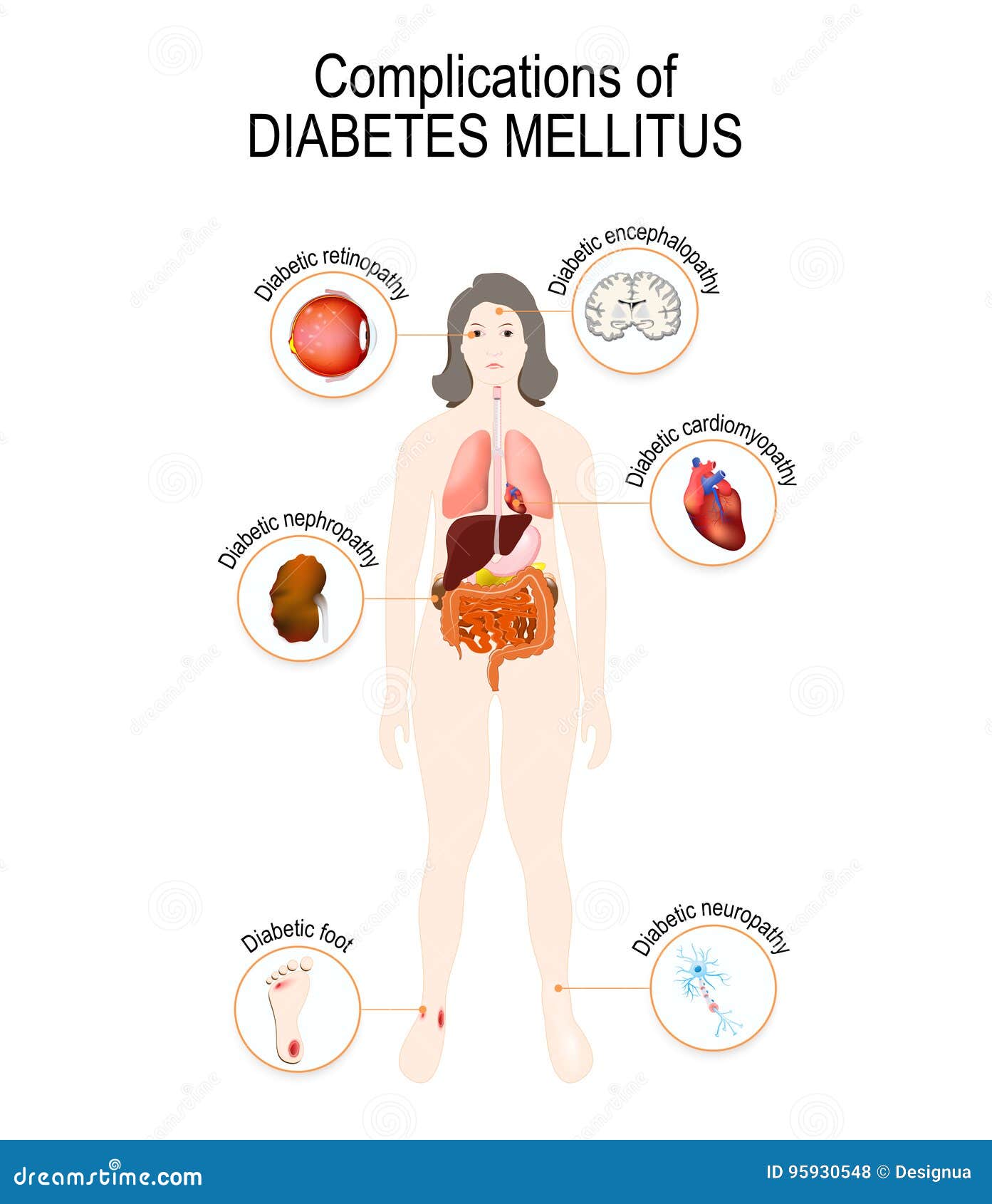 Komplikationen Des Diabetes Mellitus Vektor Abbildung - Illustration ...