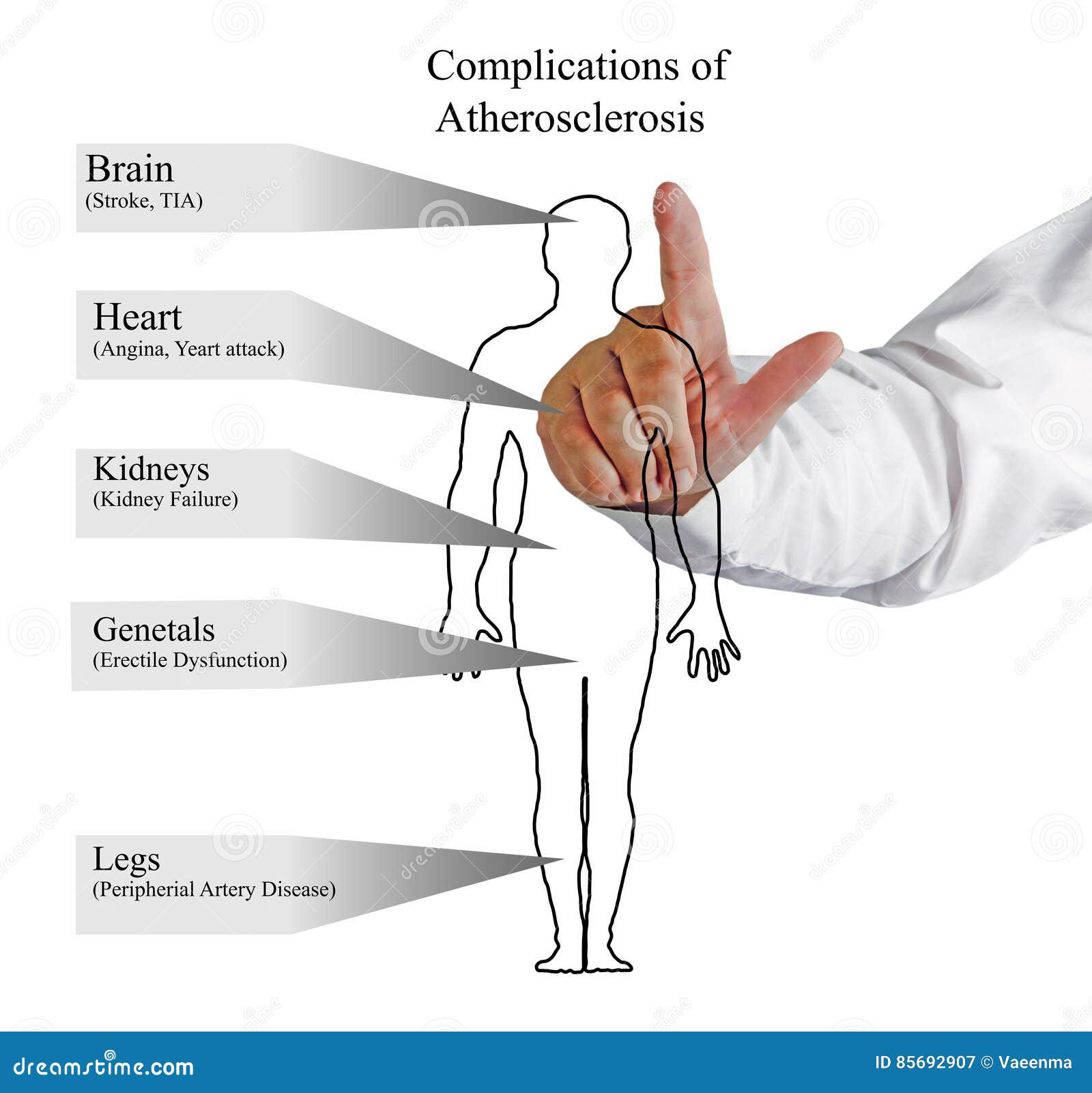 Komplikationen Von Atherosclerose Stockbild - Bild von person ...
