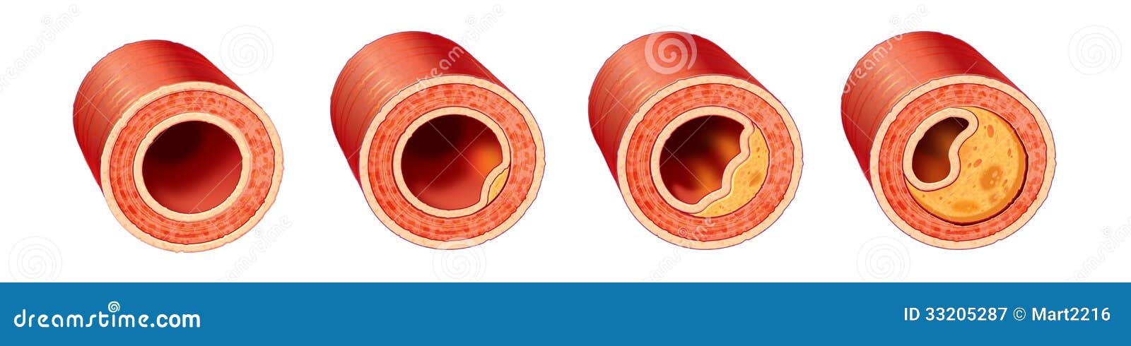 Kransslagaderziekte stock illustratie. Illustration of infarct - 33205287