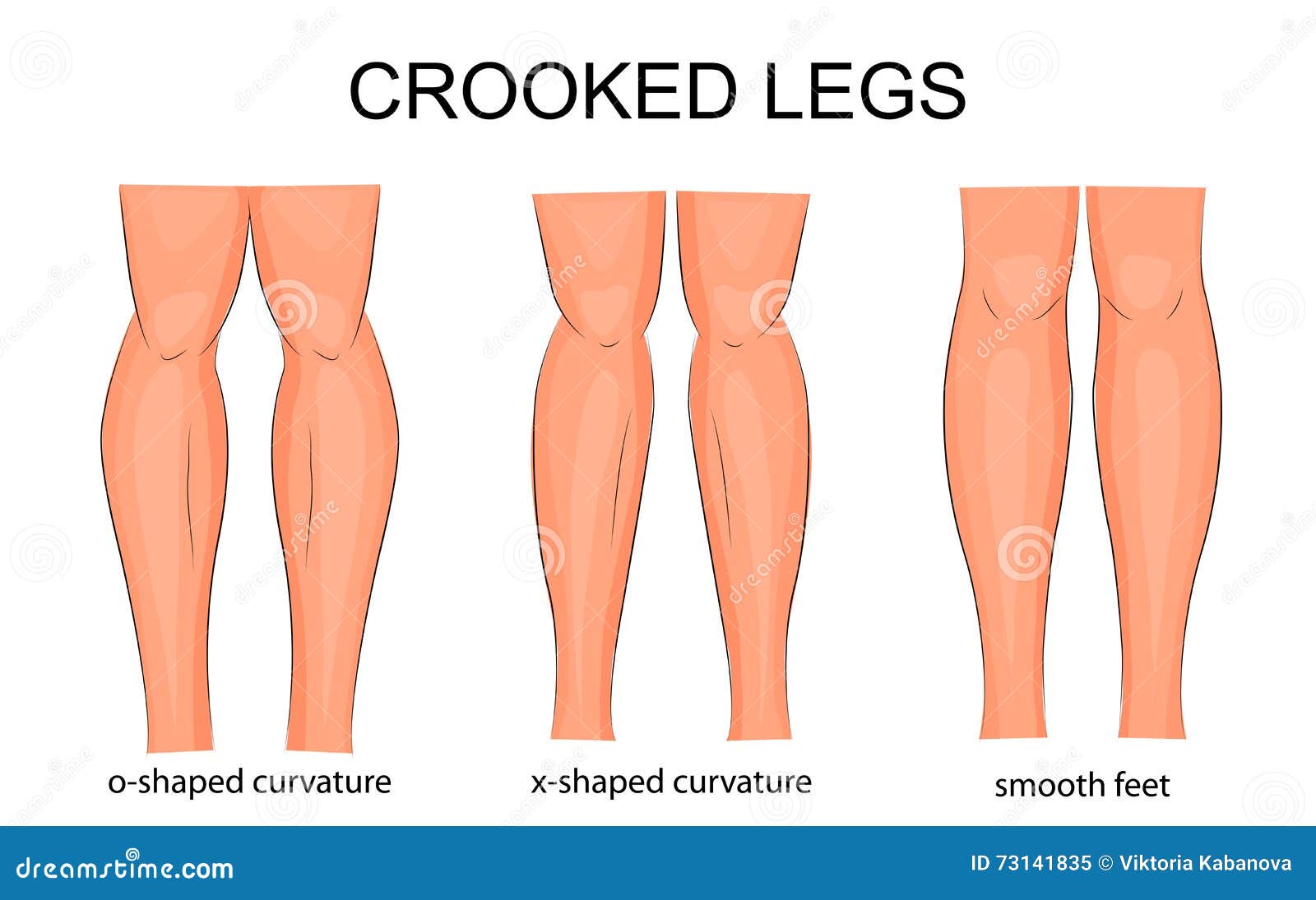 Kromming van de benen vector illustratie. Illustration of plastiek ...